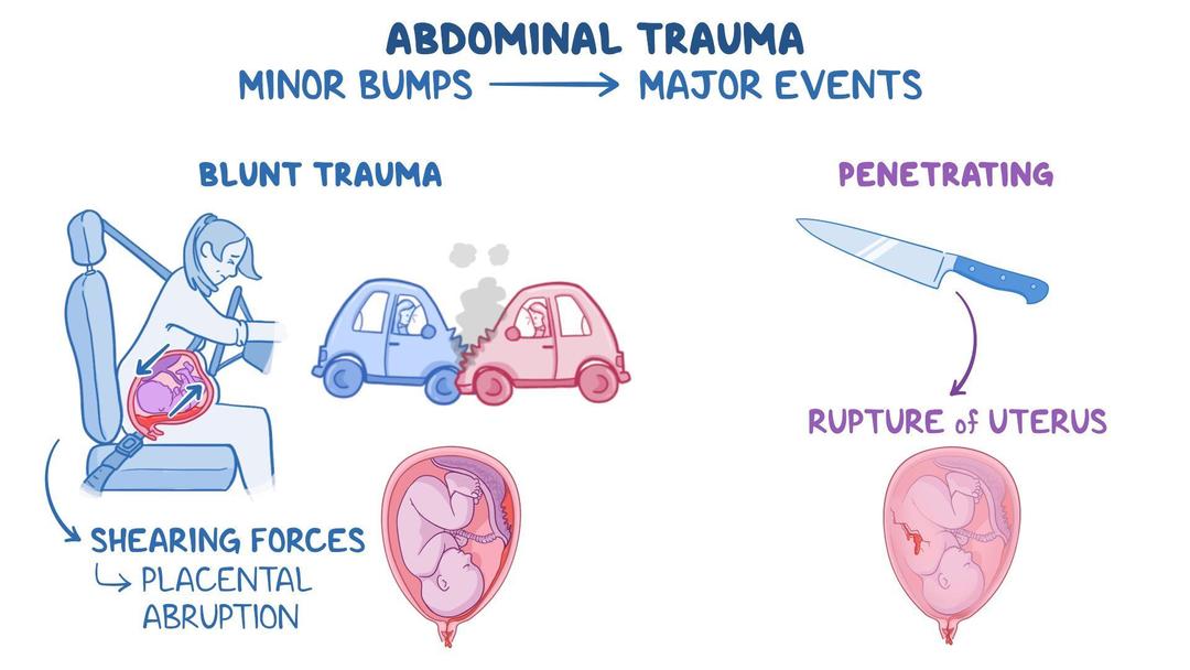 Abdominal trauma in pregnancy: Video & Meaning | Osmosis