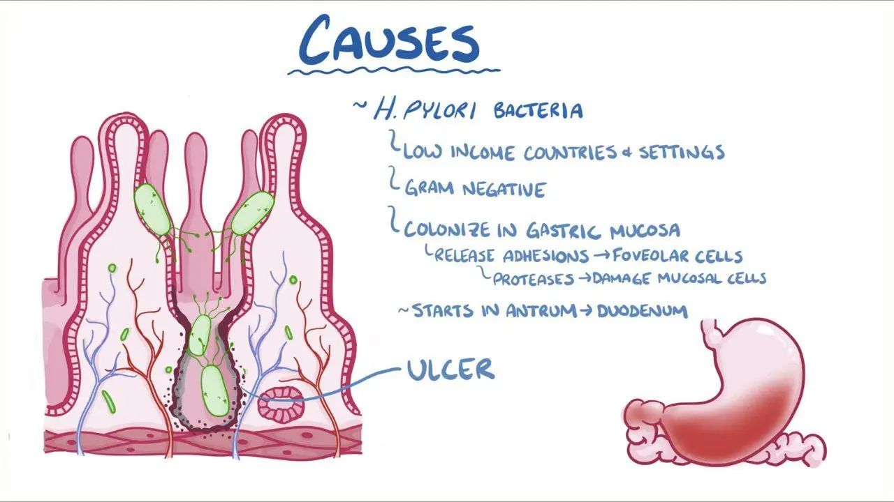 Peptic ulcer: Video, Causes, & Meaning | Osmosis