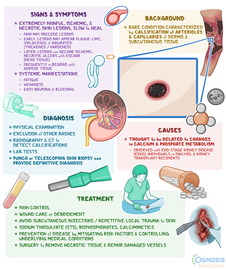 Calciphylaxis: What Is It, Signs, Symptoms, Diagnosis, and More | Osmosis