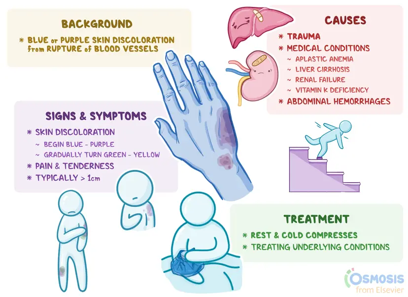 Ecchymosis: What Is It, Causes, Symptoms, and More | Osmosis