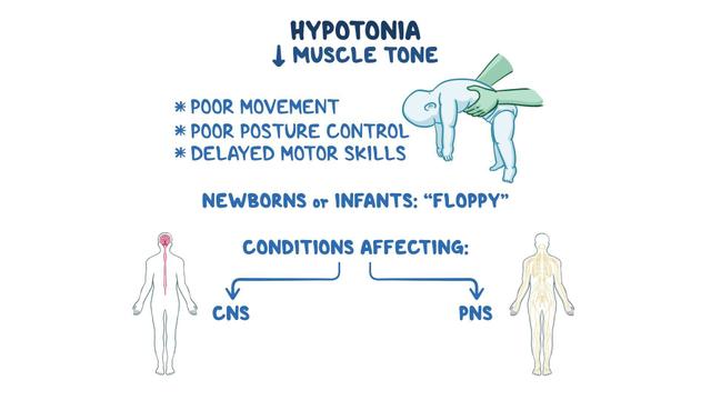 Abordaje de la hipotonía (recién nacido y lactante): ciencias clínicas ...