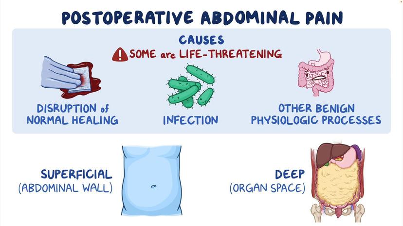 Approach to postoperative abdominal pain: Clinical sciences - Osmosis ...