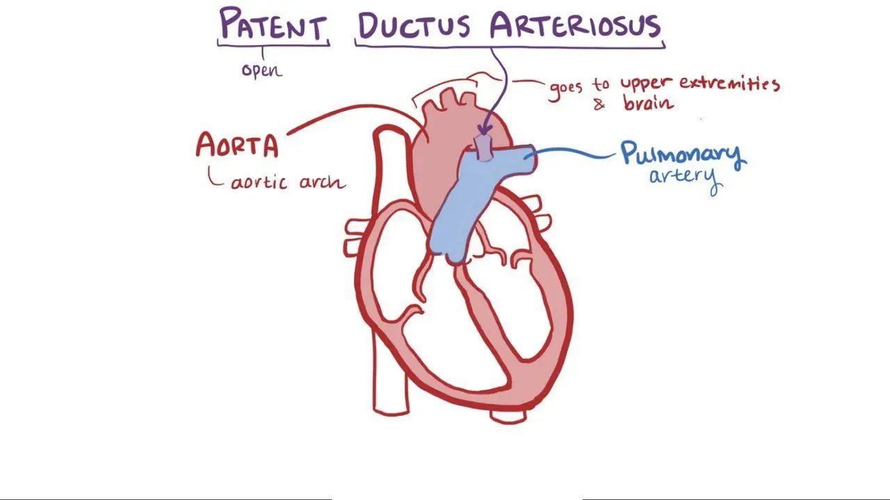 Video Patent Ductus Arteriosus Osmosis