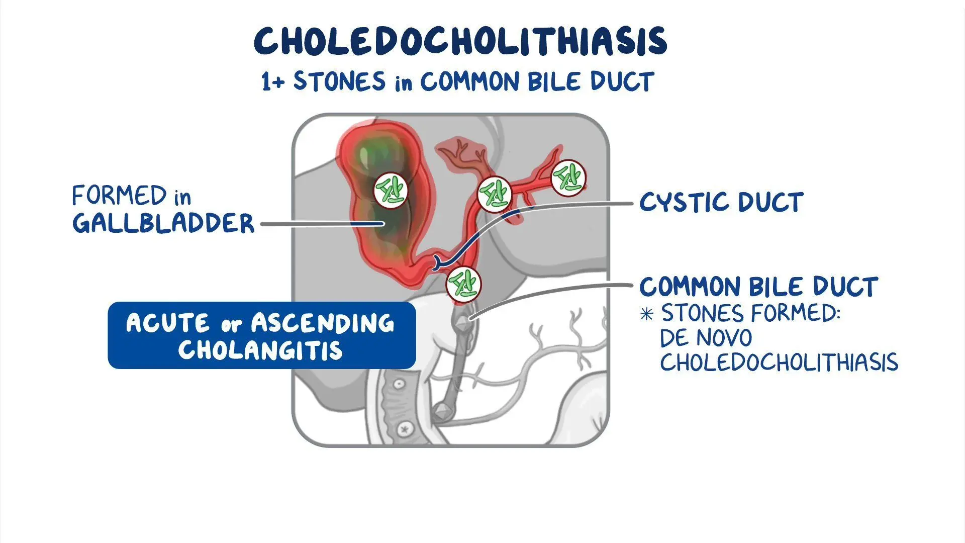 Choledocholithiasis and cholangitis: Video & Meaning | Osmosis