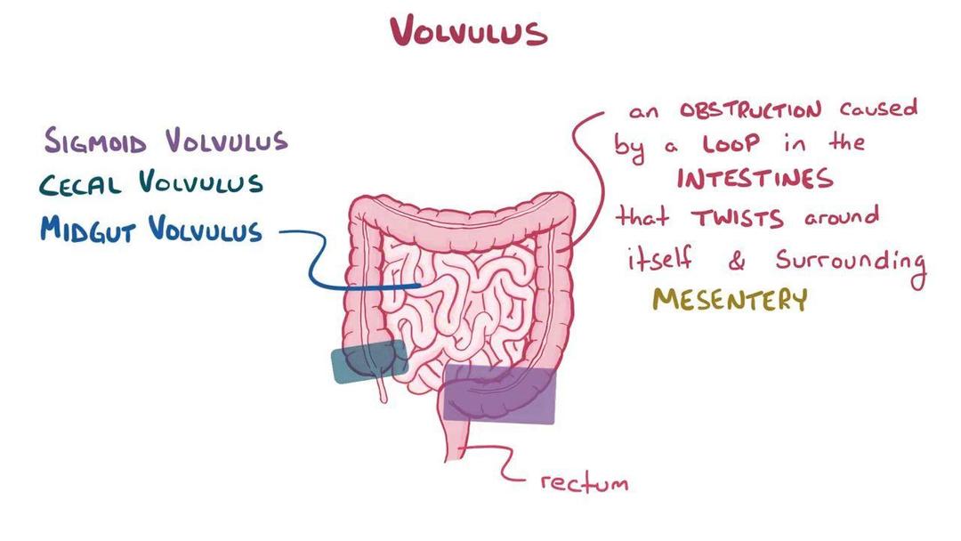Volvulus: Video, Causes, & Meaning | Osmosis