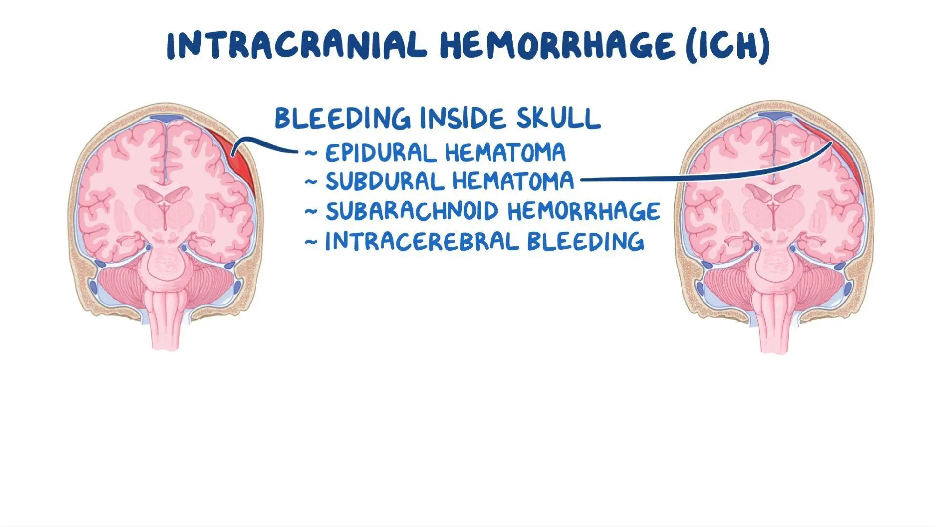 Epidural and subdural hematoma: Nursing: Video & Causes | Osmosis