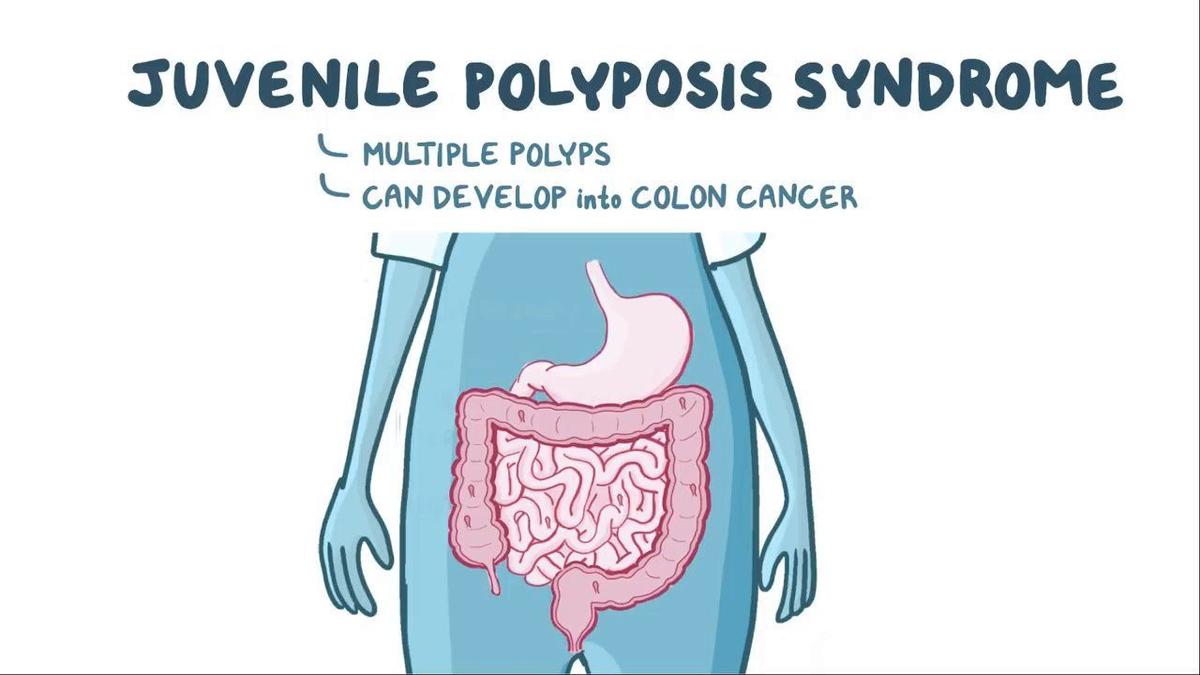 Juvenile polyposis syndrome: Video & Anatomy | Osmosis