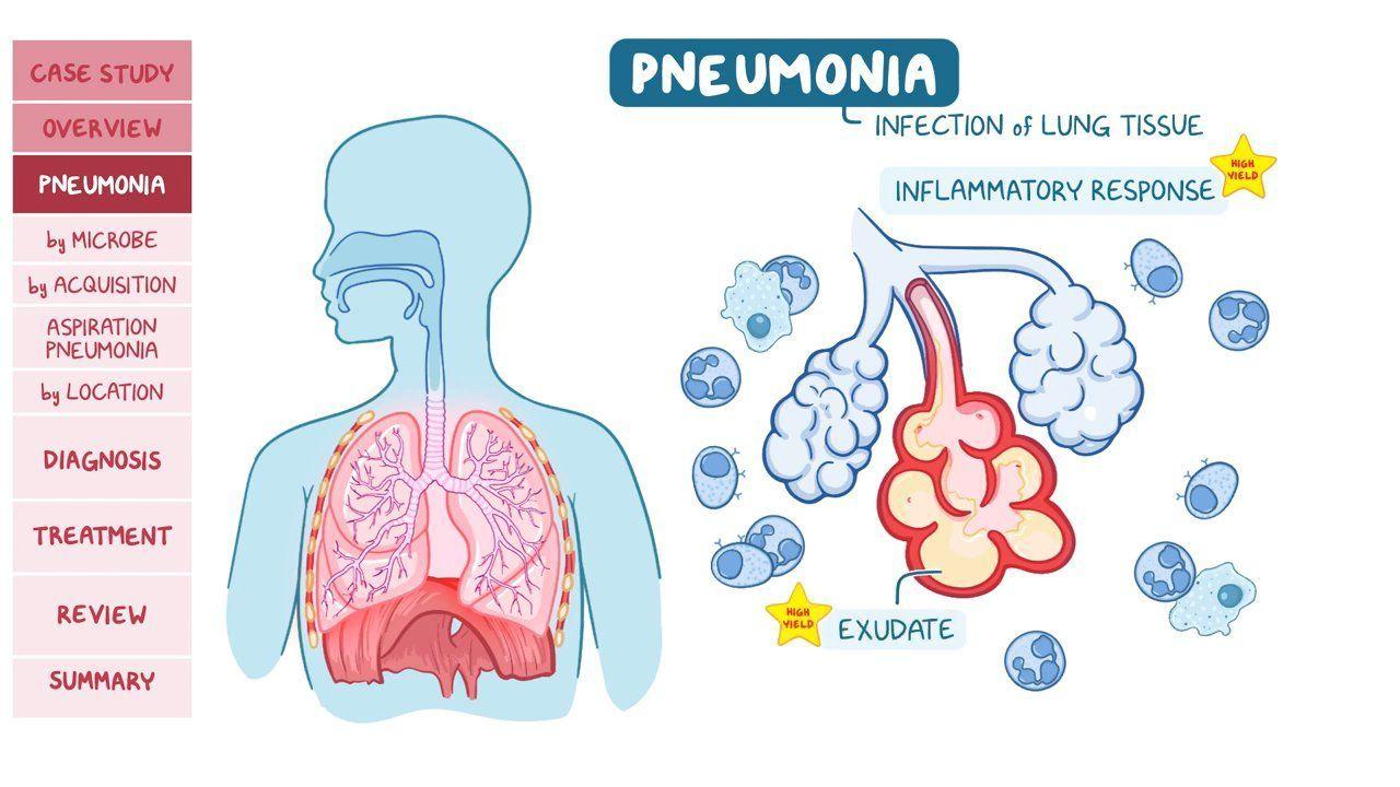 Neumonía: revisión de la patología: Vídeo & Anatomía | Osmosis