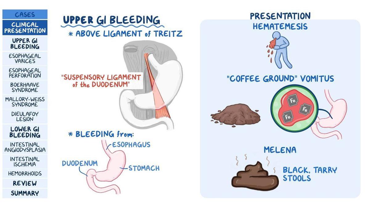 Gastrointestinal bleeding: Pathology review: Video, Causes, & Meaning ...