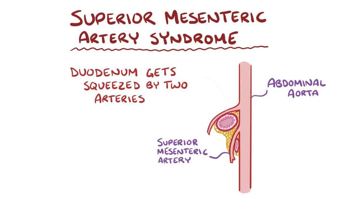 Superior mesenteric artery syndrome: Video, Causes, & Meaning | Osmosis