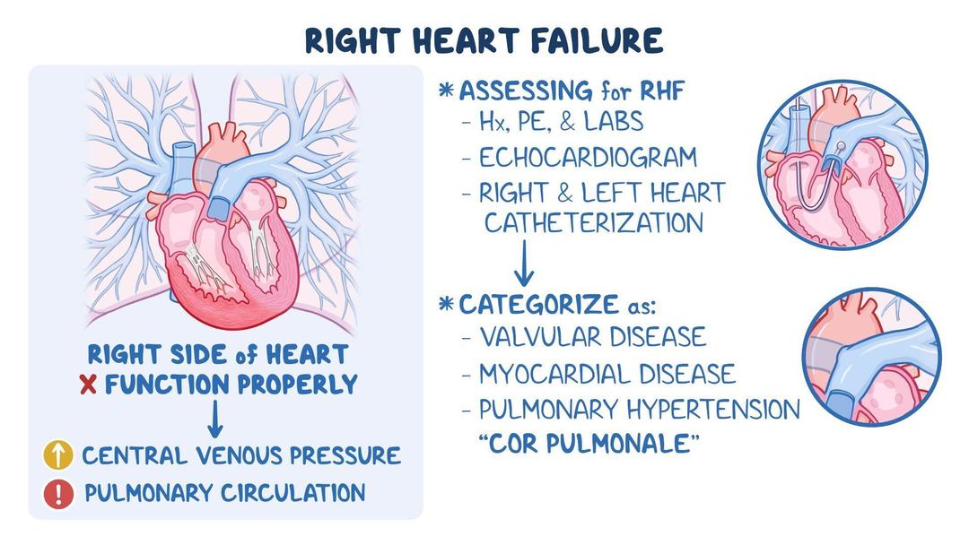 Right heart failure (cor pulmonale): Video & Meaning | Osmosis