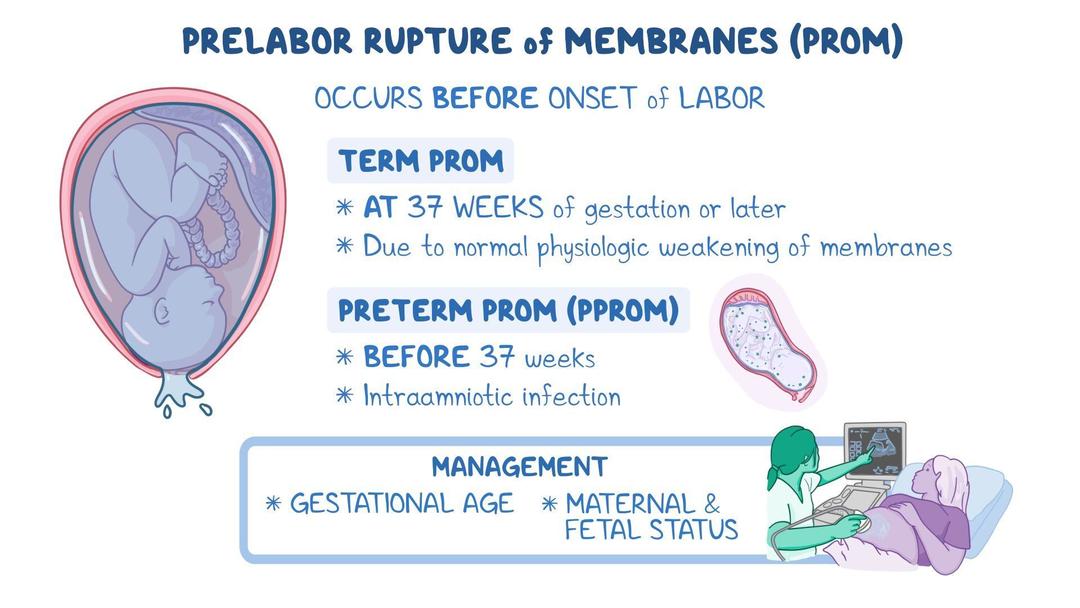 Prelabor rupture of membranes: Video & Meaning | Osmosis
