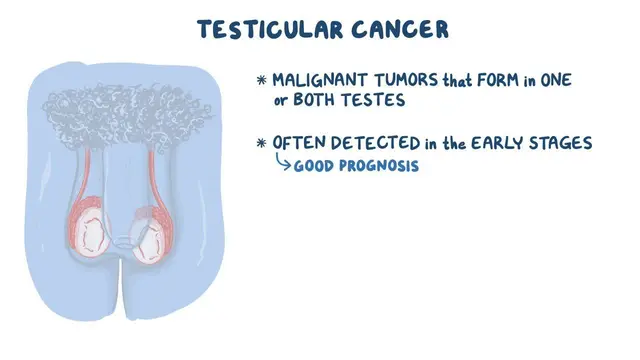 Testicular cancer: Video, Anatomy & Definition | Osmosis