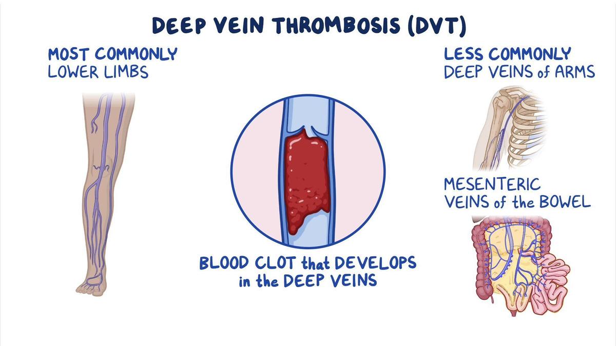 Deep vein thrombosis: Video & Meaning | Osmosis