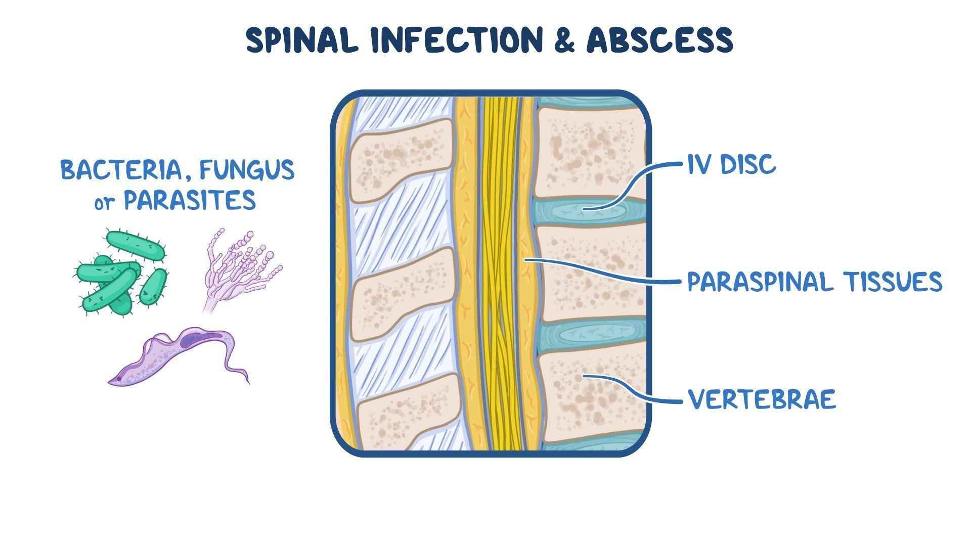 Spinal infection and abscess: Video & Meaning | Osmosis