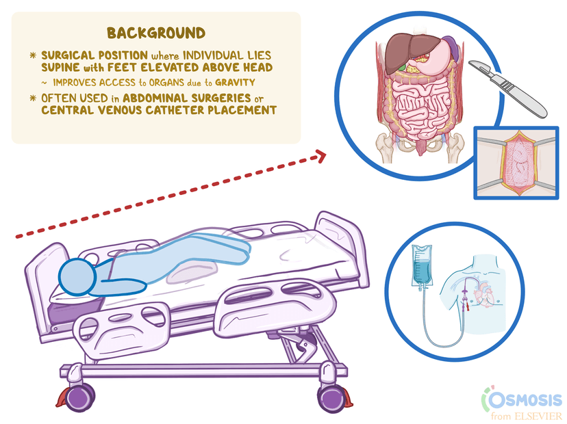Trendelenburg Position: What Is It, Uses, and More | Osmosis