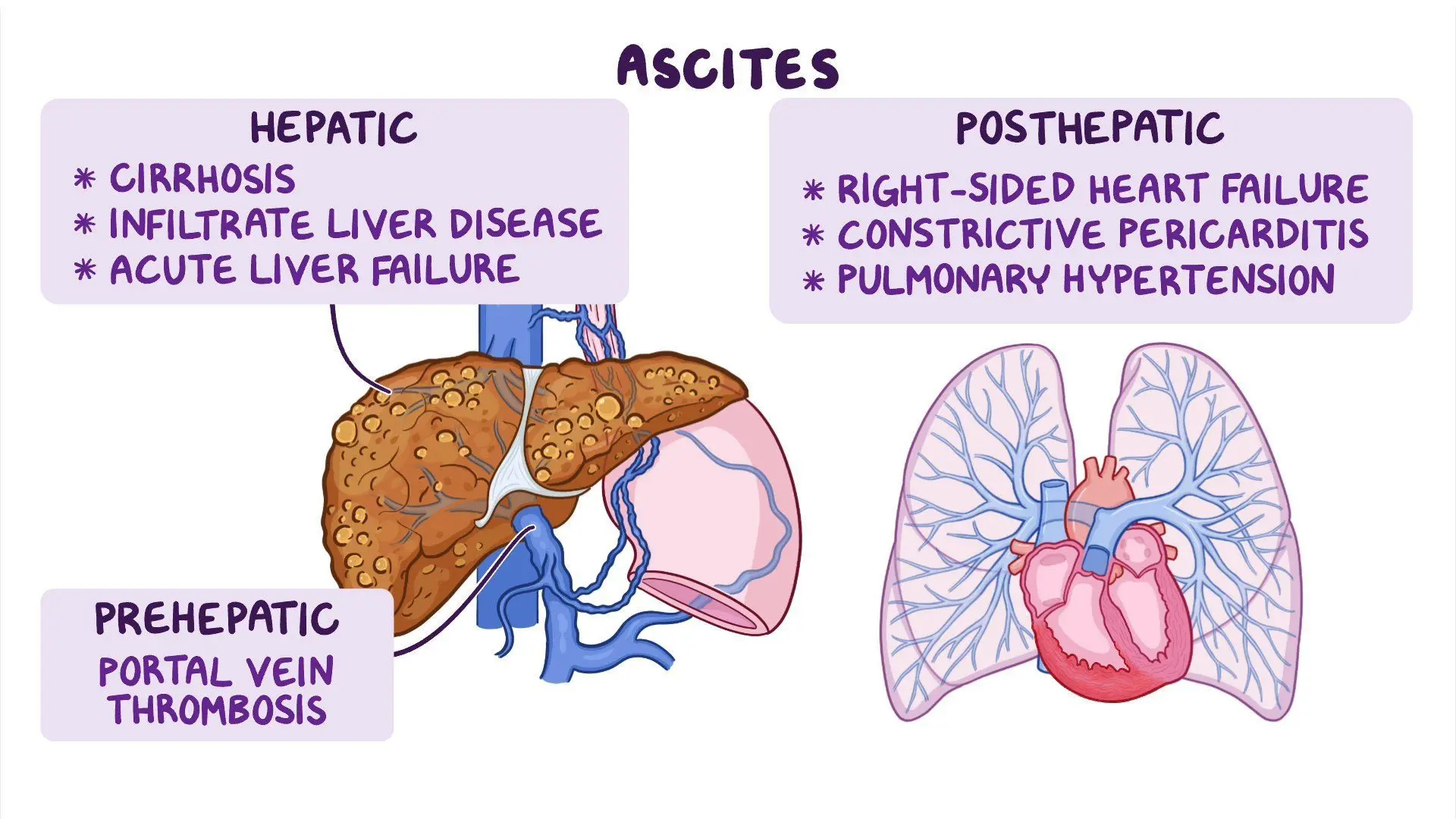 Approach to ascites: Video & Meaning | Osmosis