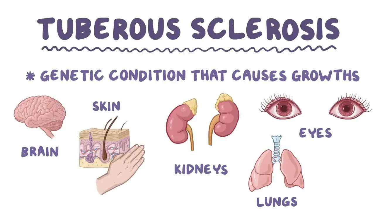 Tuberous sclerosis: Video, Causes, & Meaning | Osmosis