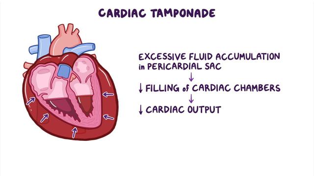 Cardiac tamponade: Clinical sciences - Osmosis Video Library