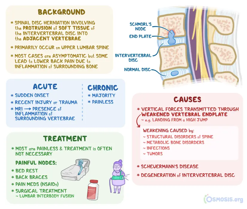 Schmorl’s Node: What Is It, Symptoms, Management, and More | Osmosis