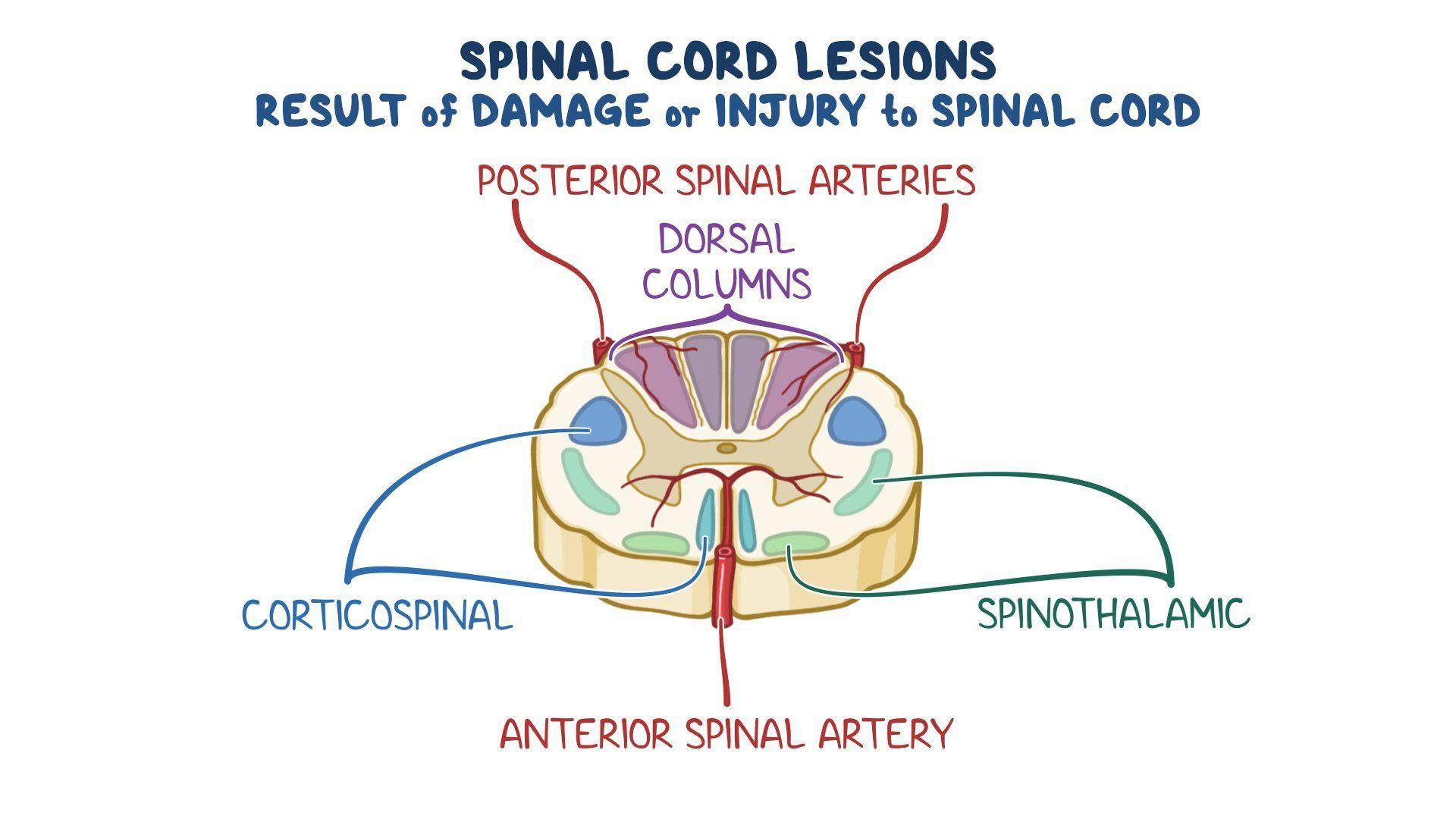 Approach to differentiating lesions (spinal cord): Video & Meaning ...