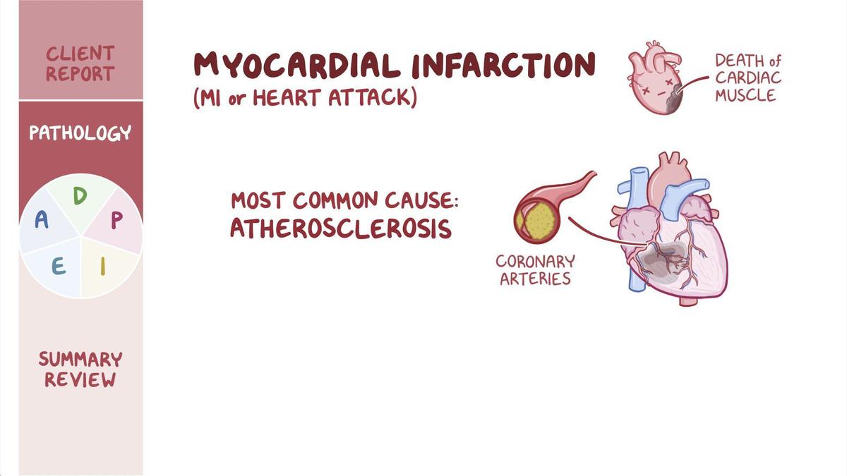 Myocardial infarction (MI): Nursing process (ADPIE) - Osmosis Video Library