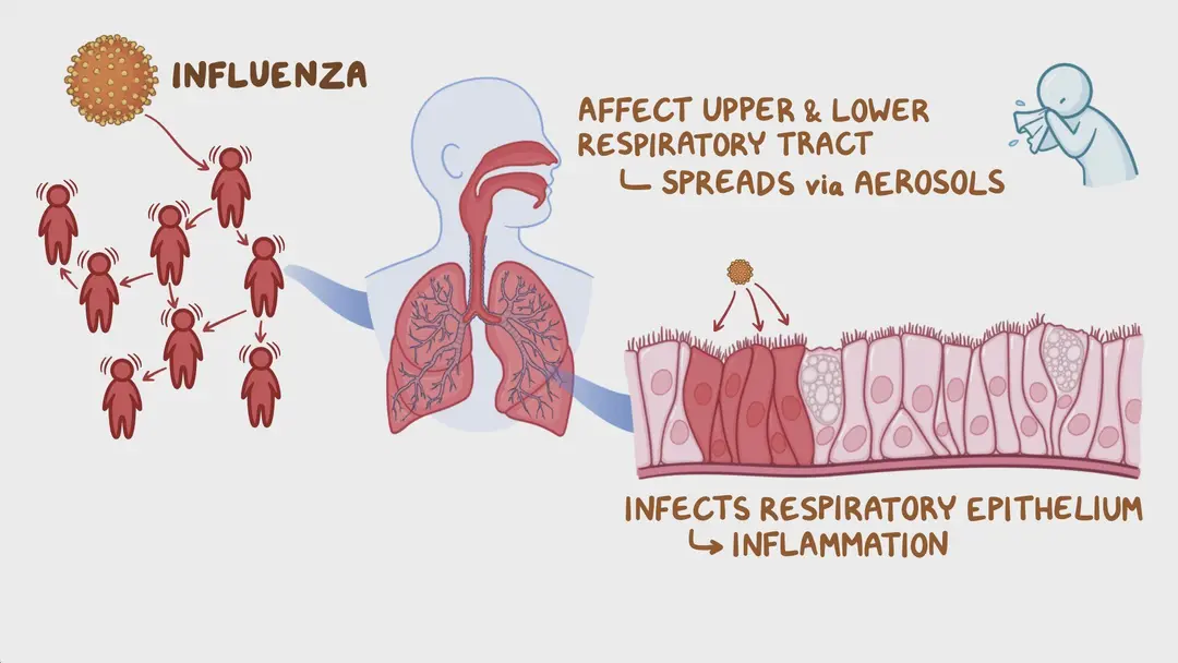Influenza: Clinical sciences - Osmosis Video Library