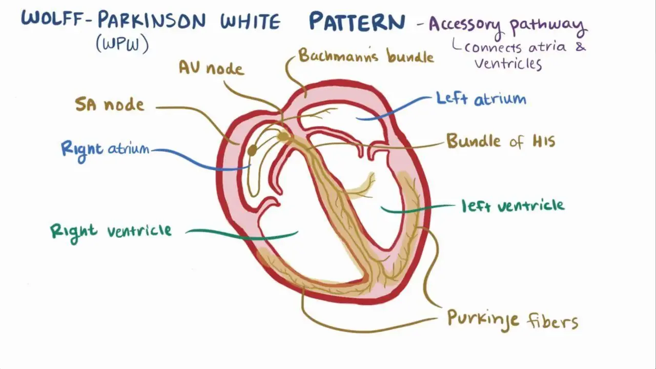 Wolff-Parkinson-White syndrome: Video, Causes, & Meaning | Osmosis