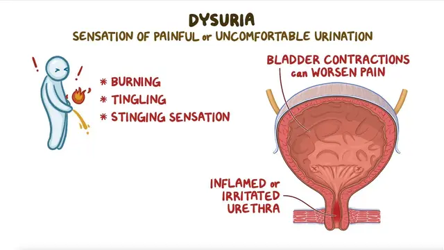 Approach to dysuria: Clinical sciences - Osmosis Video Library