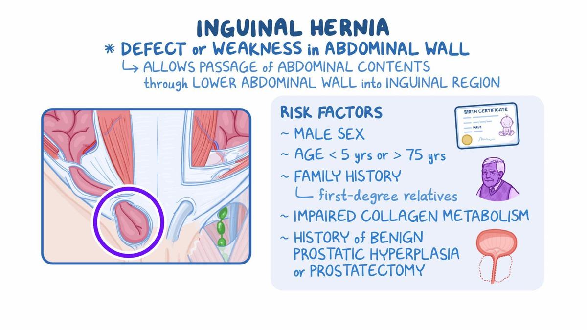 Inguinal hernias: Video & Meaning | Osmosis