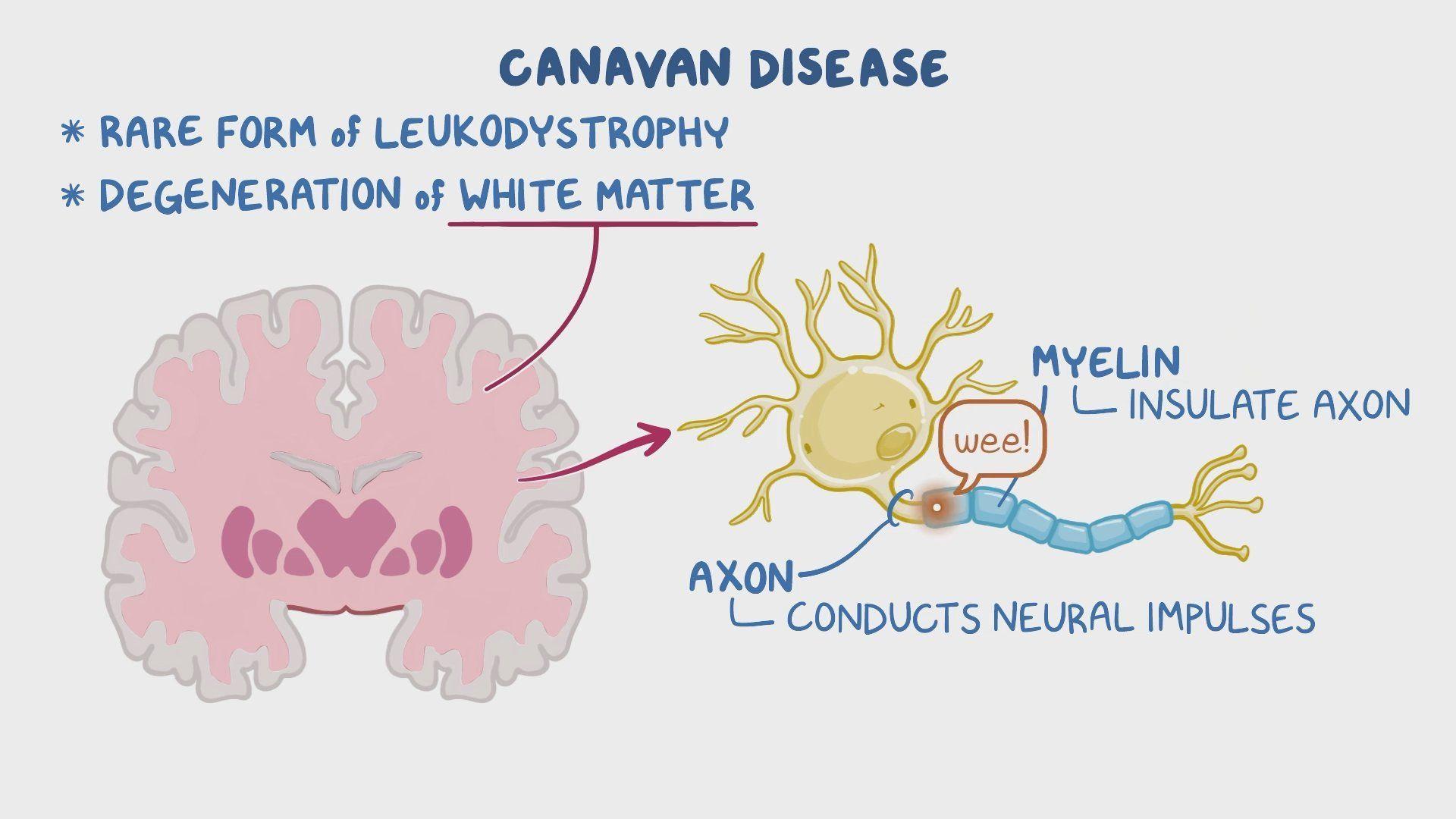 Canavan disease: Video & Causes | Osmosis