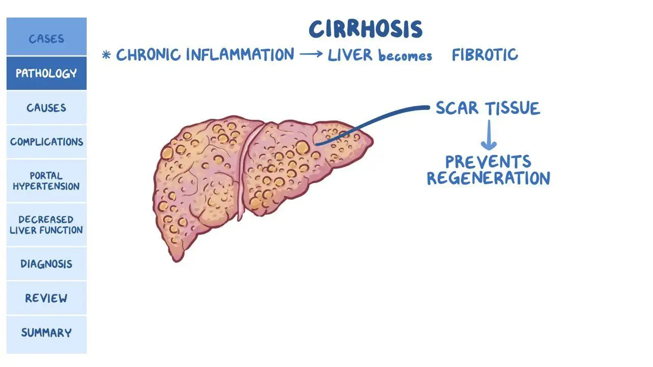 Cirrhosis: Pathology review: Video, Causes, & Meaning | Osmosis