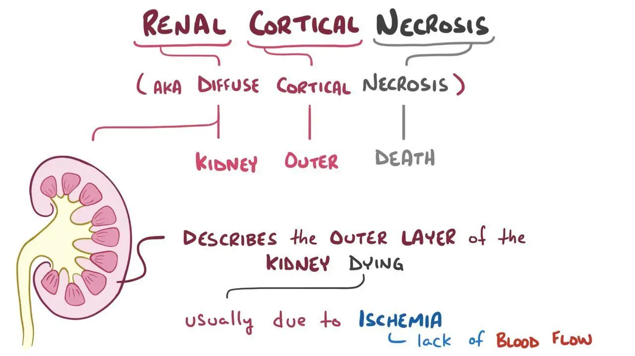 Renal cortical necrosis: Video, Causes, & Meaning | Osmosis
