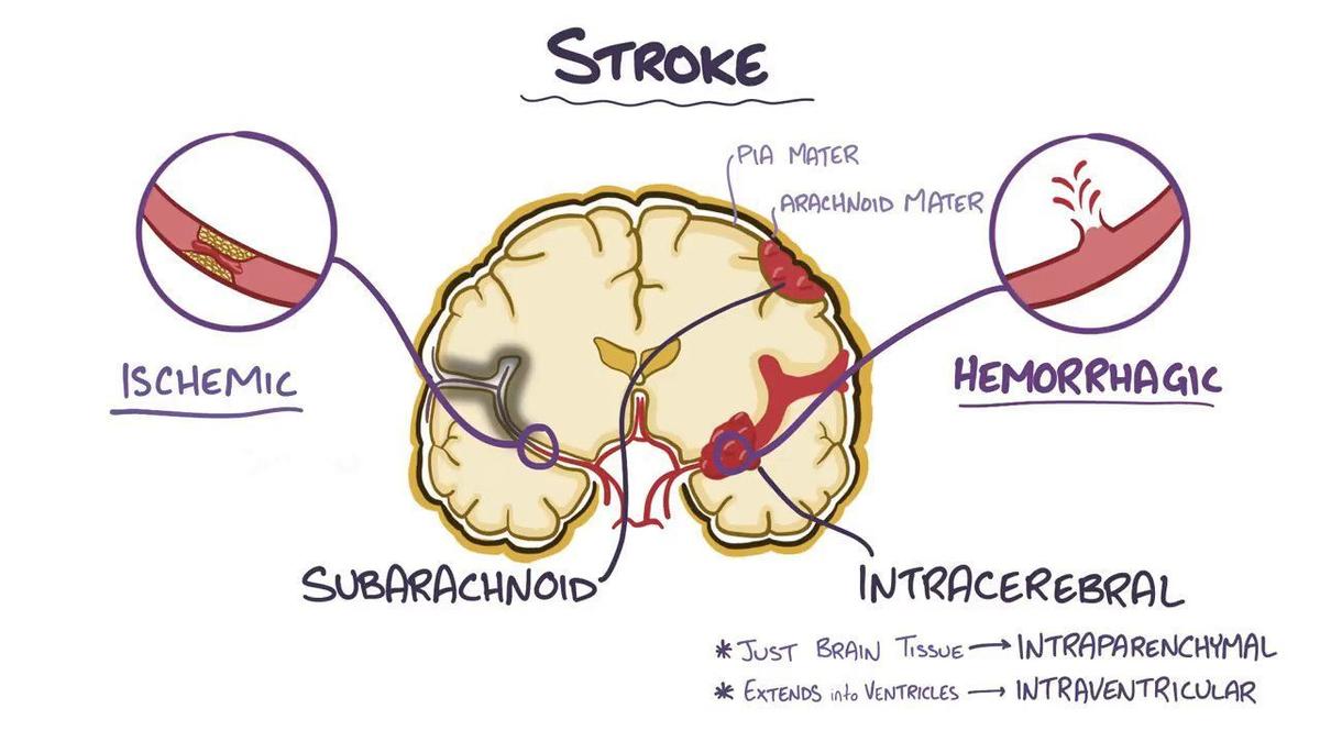 Intracerebral hemorrhage: Video, Causes, & Meaning | Osmosis