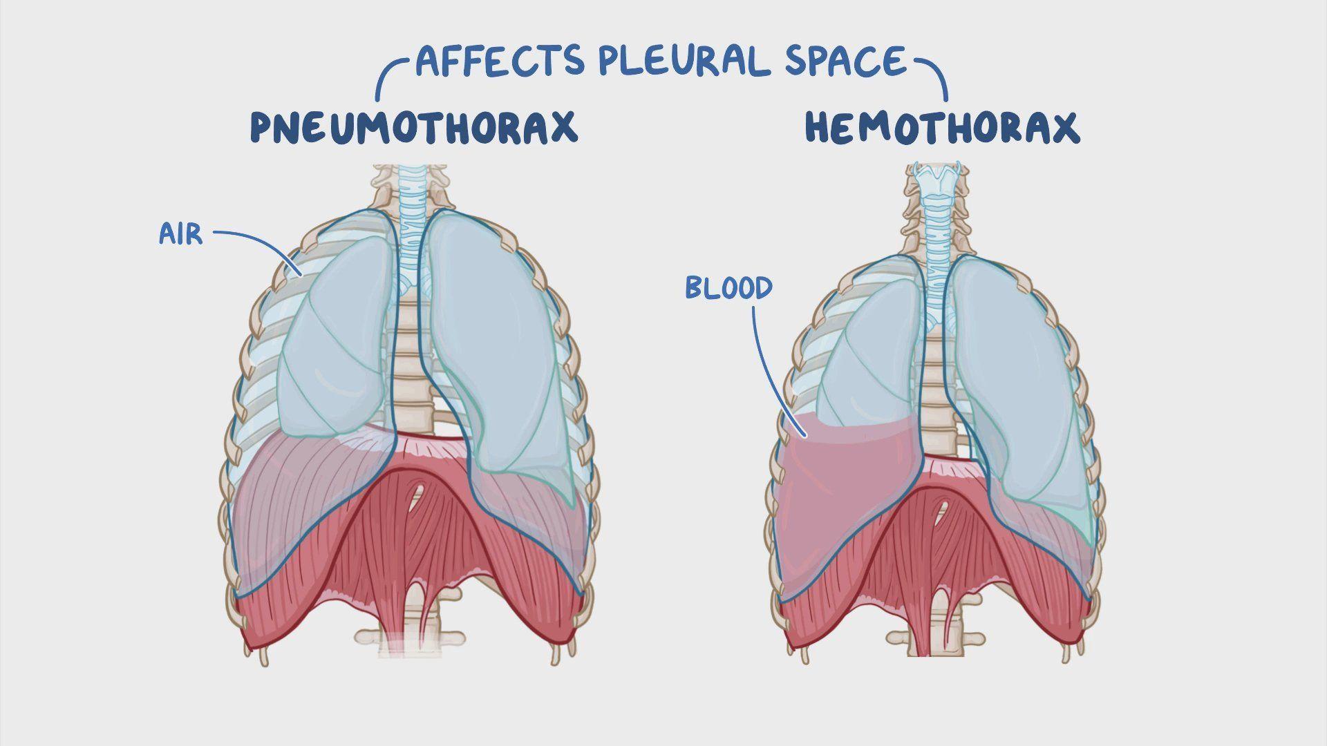 Pneumothorax and hemothorax: Nursing: Video & Causes | Osmosis