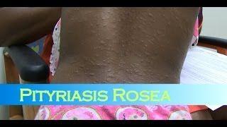 Pityriasis rosea: Video, Anatomy, Definition & Function | Osmosis
