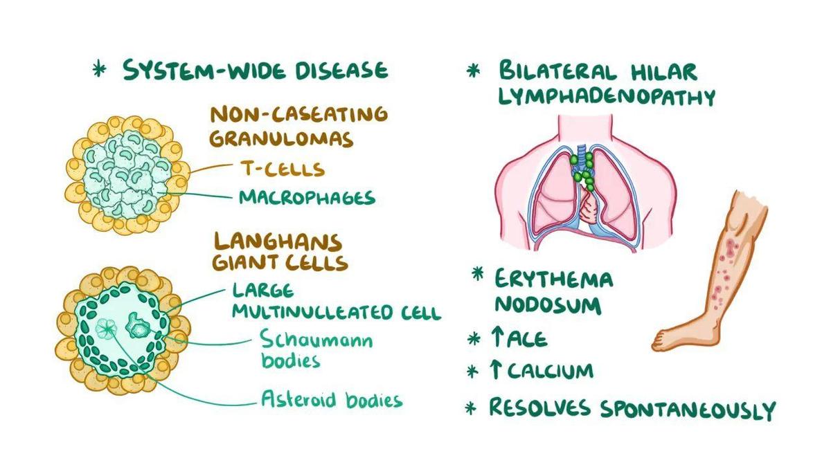 Sarcoidosis: Video, Anatomy, Definition & Function | Osmosis