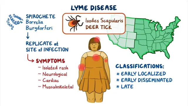 Lyme disease: Clinical sciences - Osmosis Video Library