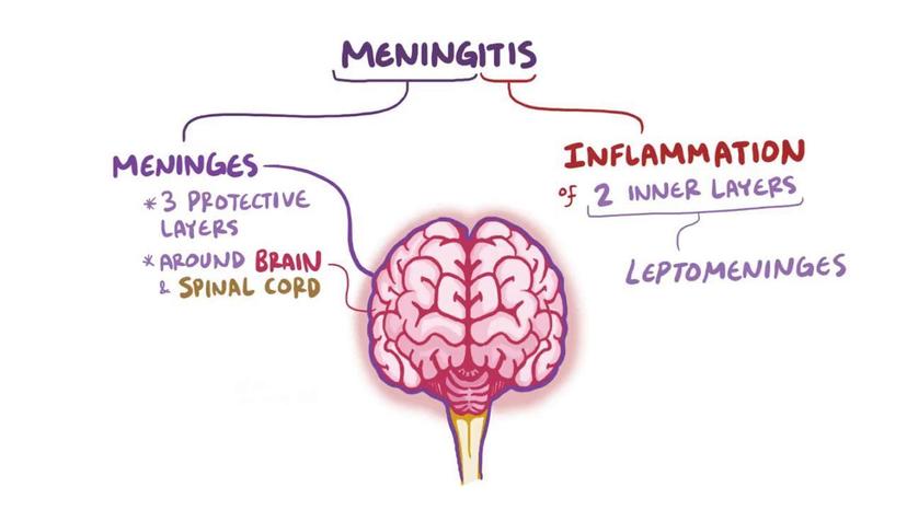 Meningitis: Video, Causes, & Meaning | Osmosis