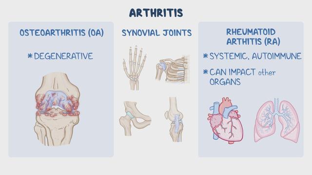 Osteoarthritis and rheumatoid arthritis: Nursing pathophysiology: Video ...