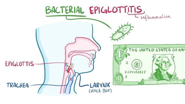 Epiglotitis bacteriana: Vídeo, Anatomía & Definición | Osmosis