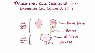 Bladder cancer Notes: Diagrams & Download PDF | Osmosis