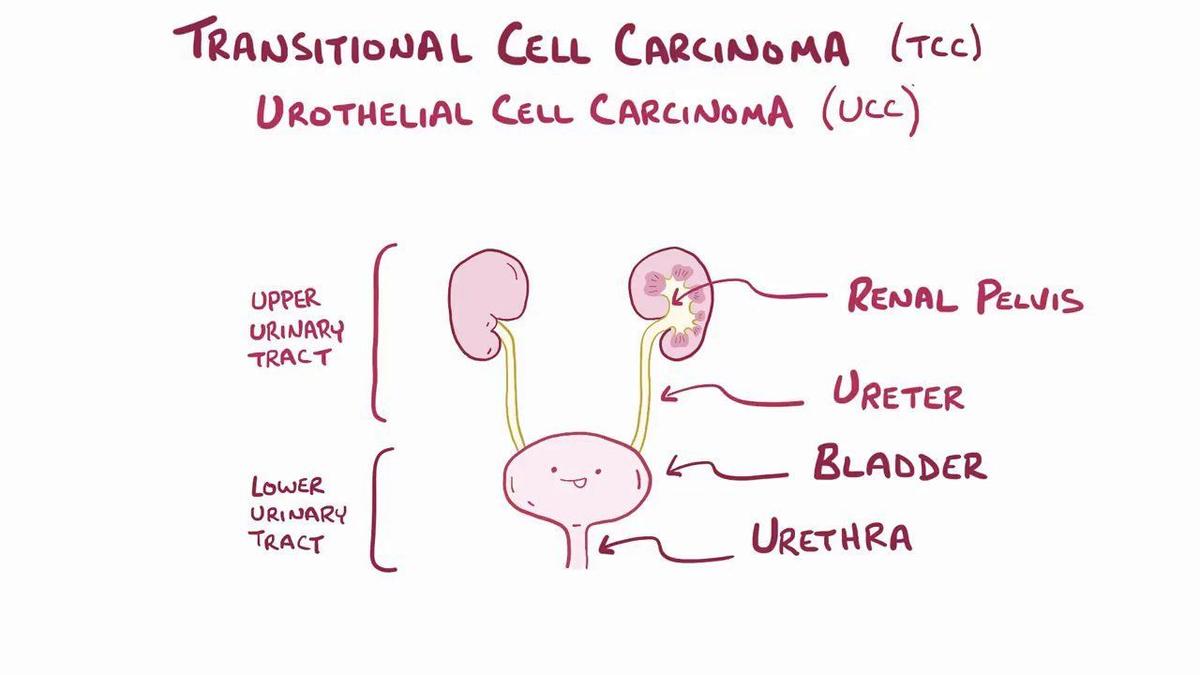 Carcinoma de células transicionales: Vídeo & Anatomía | Osmosis