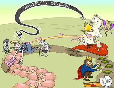 Whipple's disease: Video, Anatomy & Definition | Osmosis