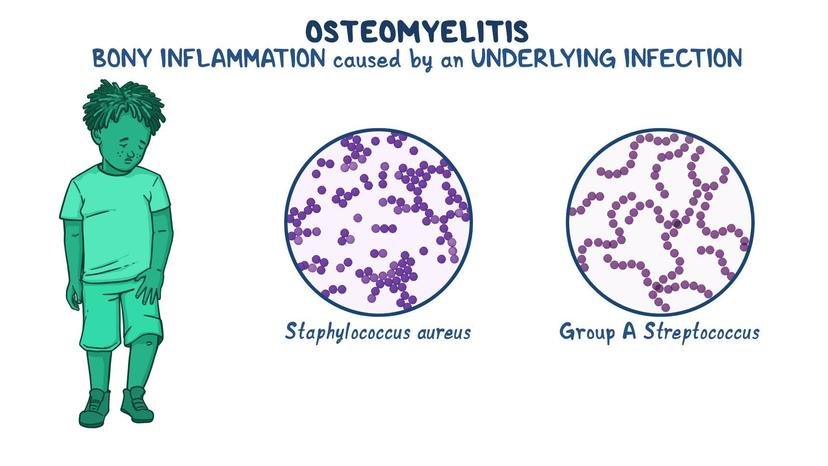 Osteomyelitis (pediatrics): Clinical sciences - Osmosis Video Library