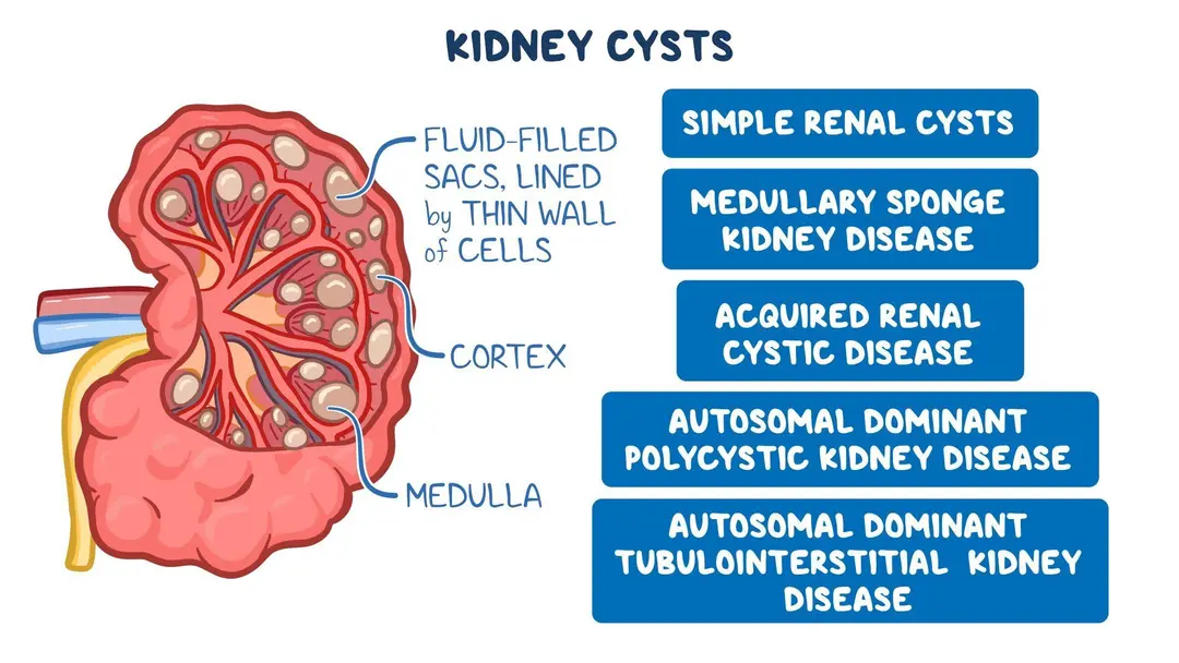 Approach to cystic kidney disease: Video & Meaning | Osmosis