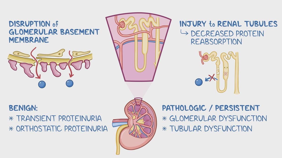 Approach to proteinuria (pediatrics): Video & Meaning | Osmosis