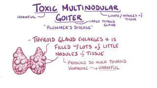 Hyperthyroidism and hypothyroidism Notes: Diagrams & Download PDF | Osmosis