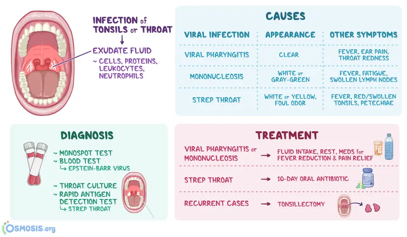 Tonsillar Exudate: What Is It, Causes | Osmosis