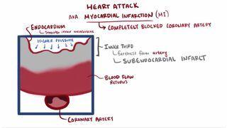 Acute coronary syndromes Notes: Diagrams & Download PDF | Osmosis